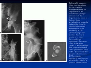 Acetabular fractures.ppt