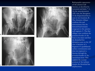 Acetabular fractures.ppt