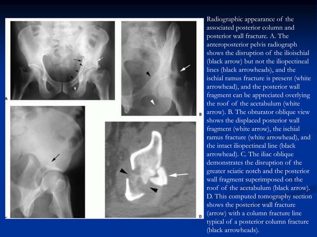 Acetabular fractures.ppt