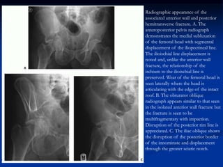 Acetabular fractures.ppt