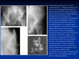 Acetabular fractures.ppt