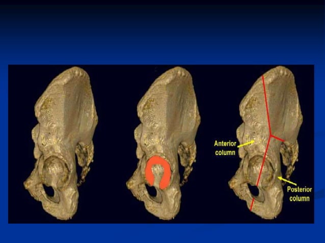 Acetabular fractures.ppt