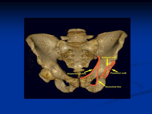 Acetabular fractures.ppt