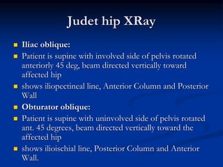 Acetabular fractures.ppt