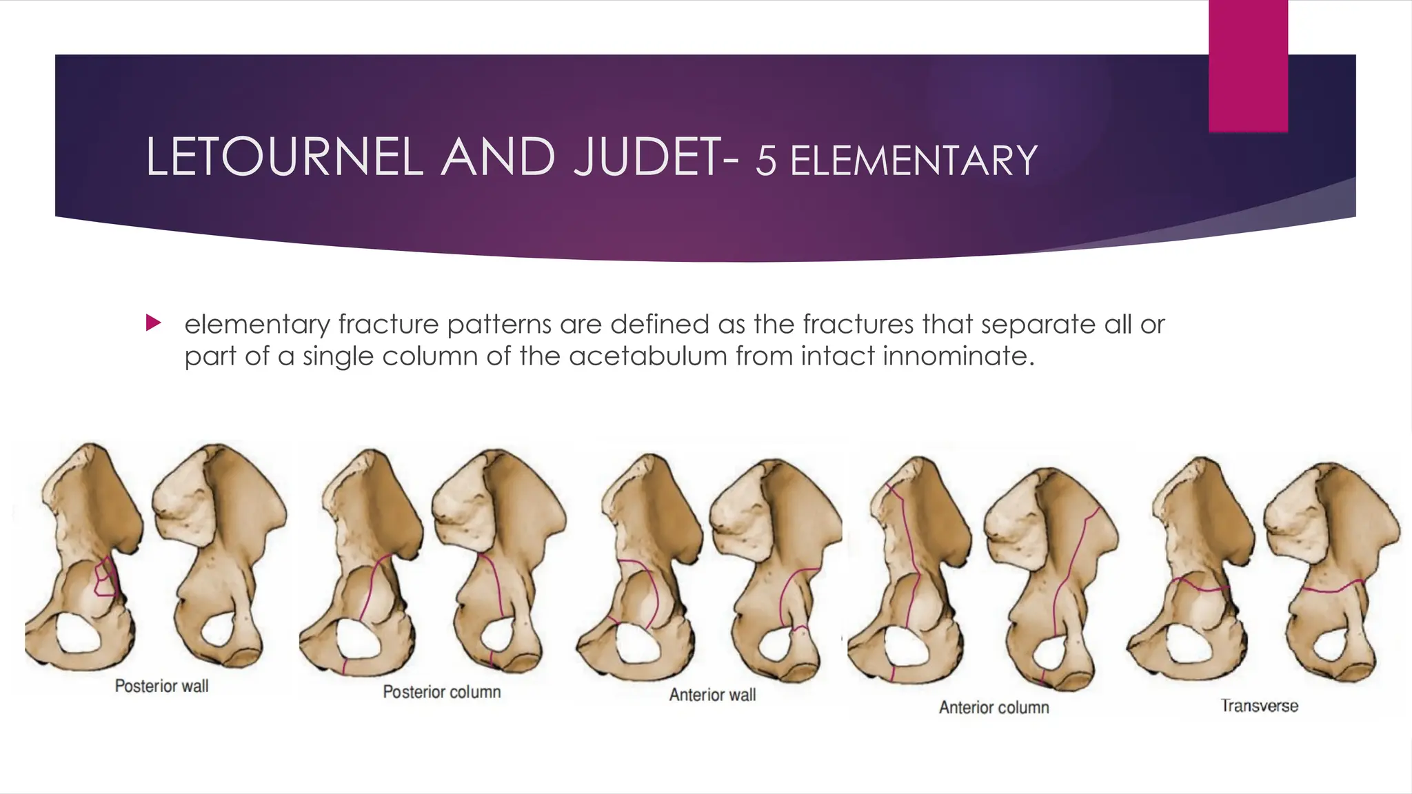 Acetabular fractures- Etiology , clinical features and management | PPTX