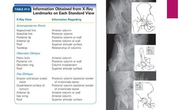 Acetabular fractures- Etiology , clinical features and management | PPTX