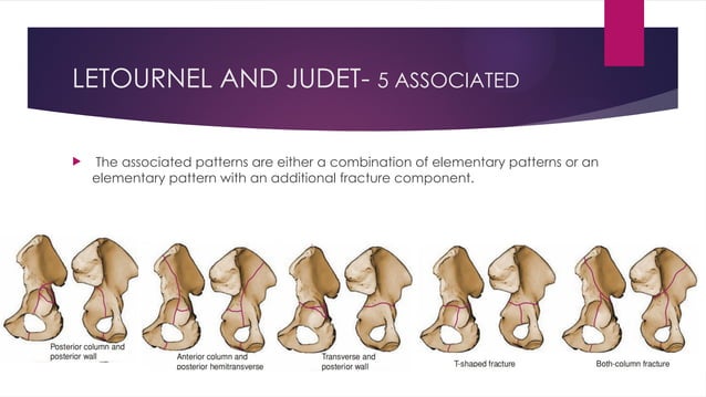 Acetabular fractures- Etiology , clinical features and management | PPTX