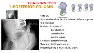 Acetabular Fractures 2.................. | PPTX