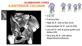 Acetabular Fractures 2.................. | PPTX