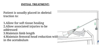 Acetabular Fractures 2.................. | PPTX