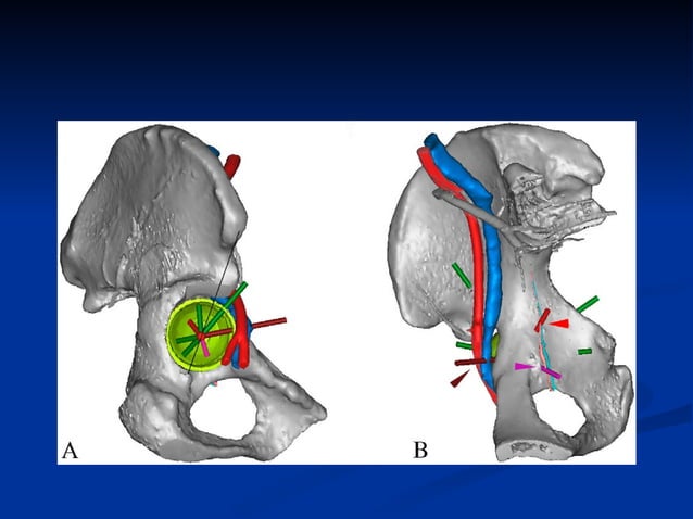 Acetabular revision | PPT