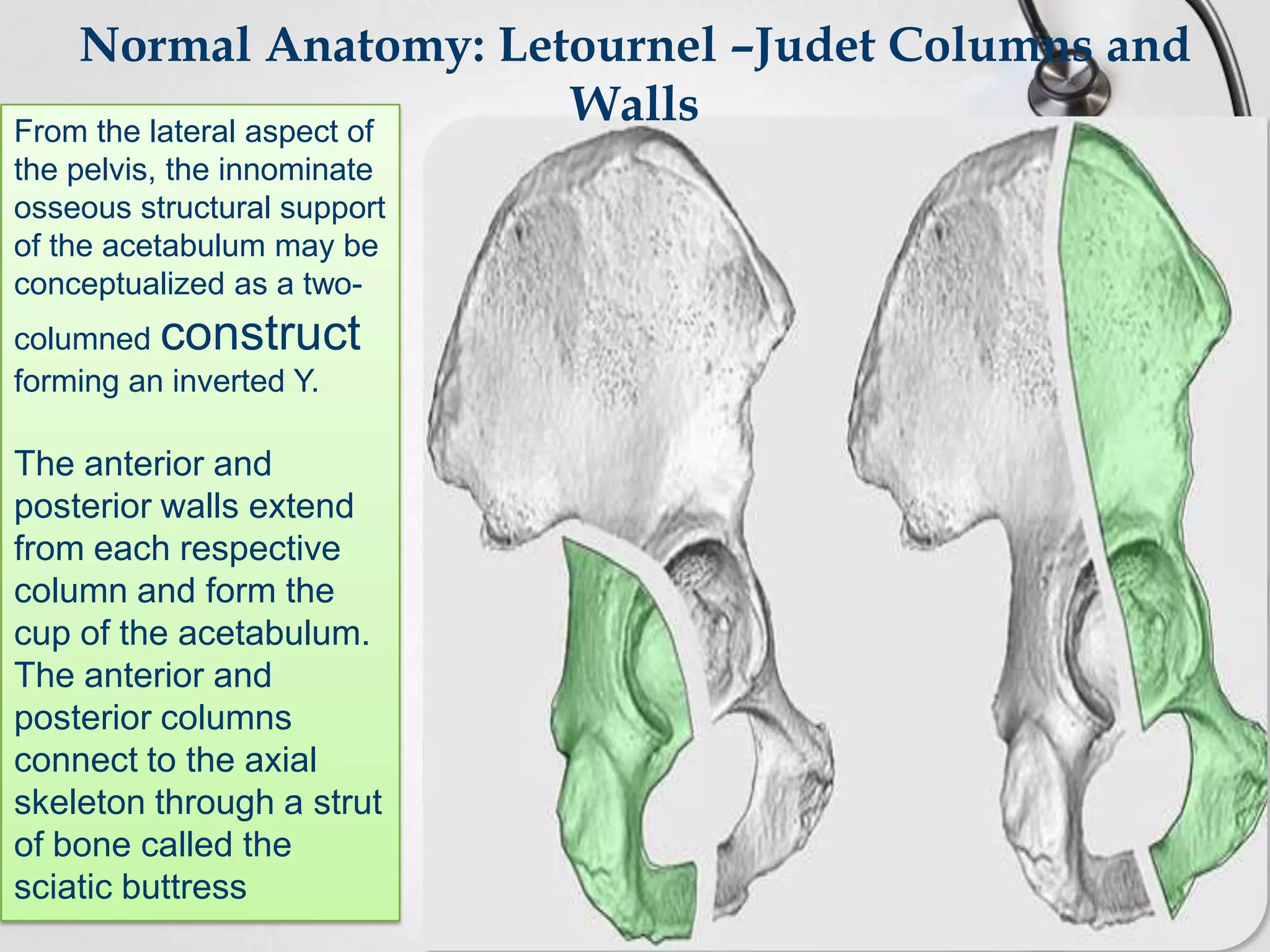 Acetabular fracture | PPTX