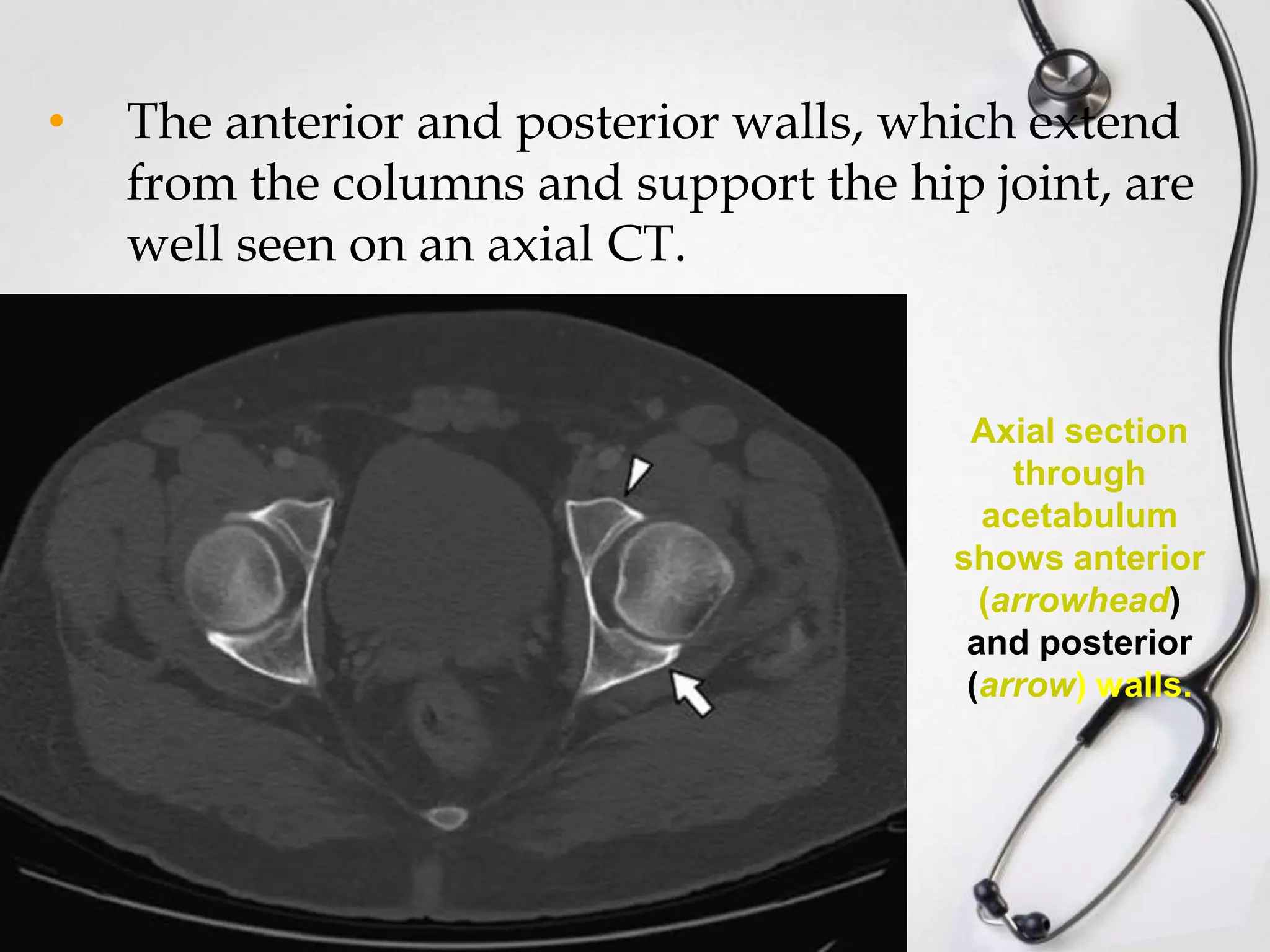 Acetabular fracture | PPTX