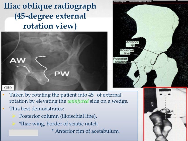 Acetabular fracture