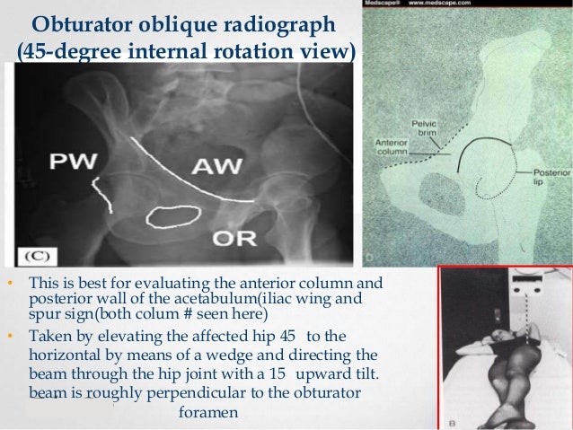 Acetabular fracture
