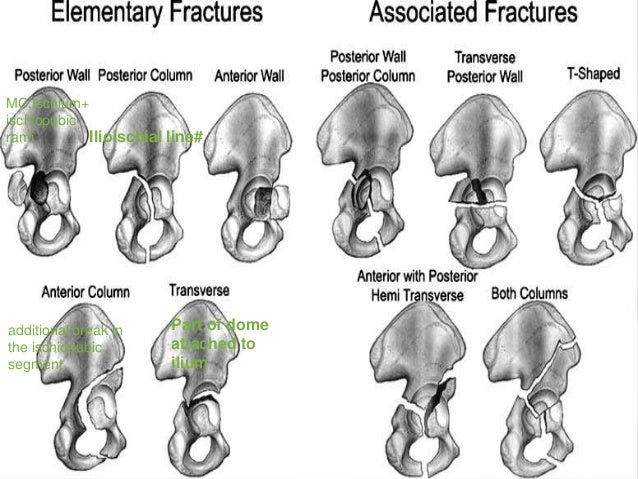 Acetabular fracture