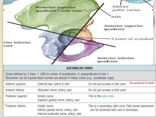 Acetabular fracture