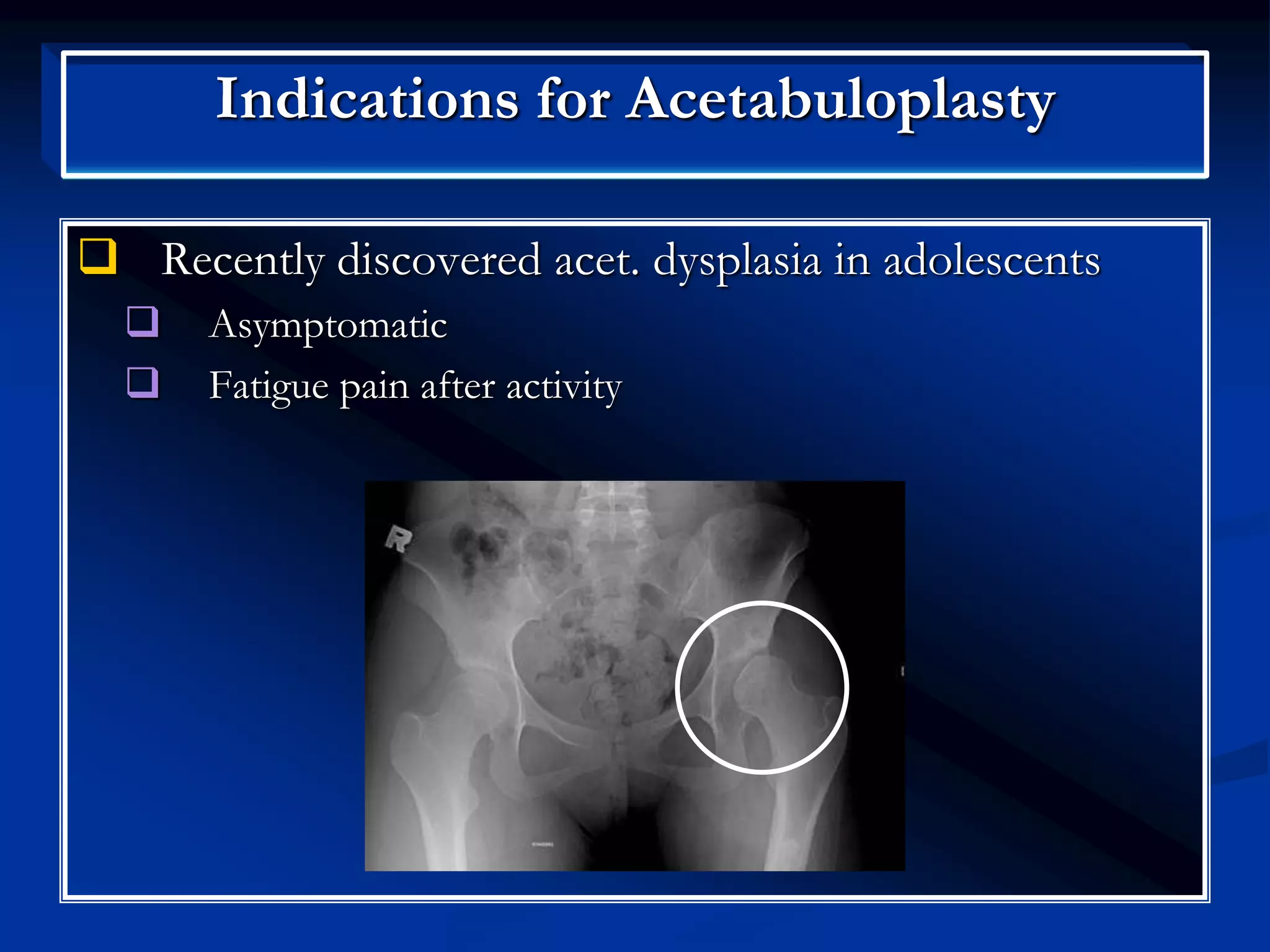 Acetabuloplasty indications | PPT