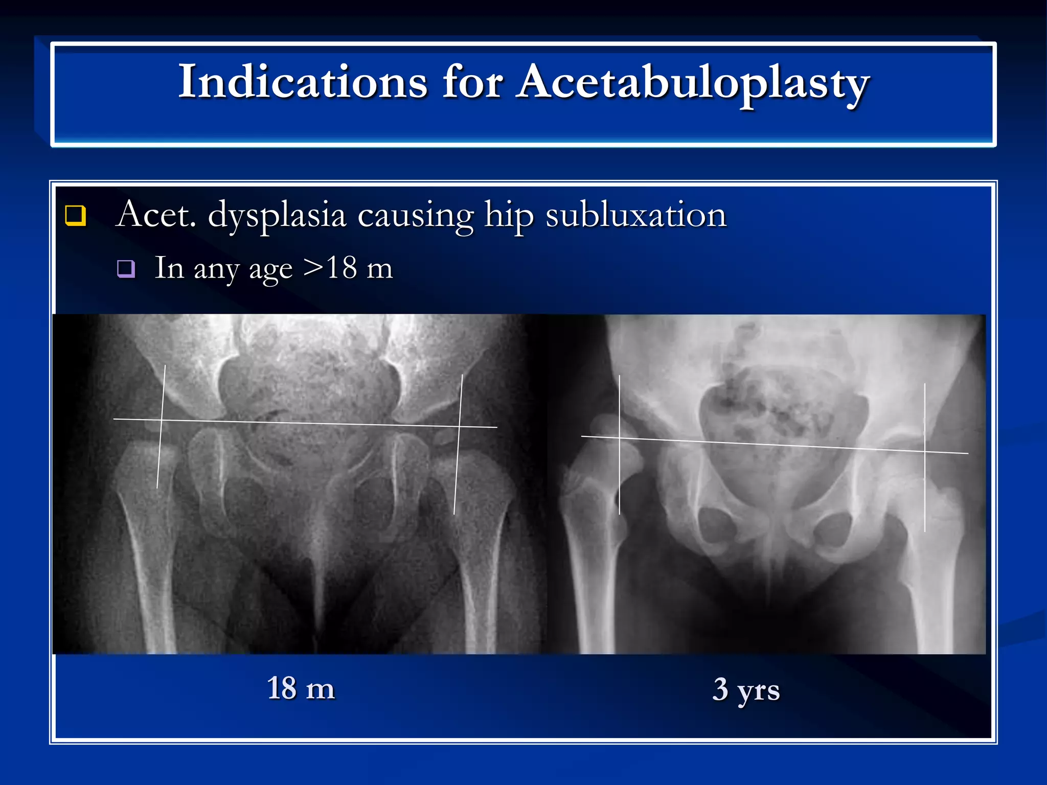 Acetabuloplasty indications | PPT