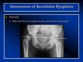 Acetabuloplasty indications | PPT