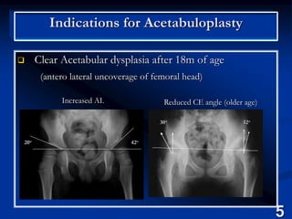 Acetabuloplasty indications | PPT