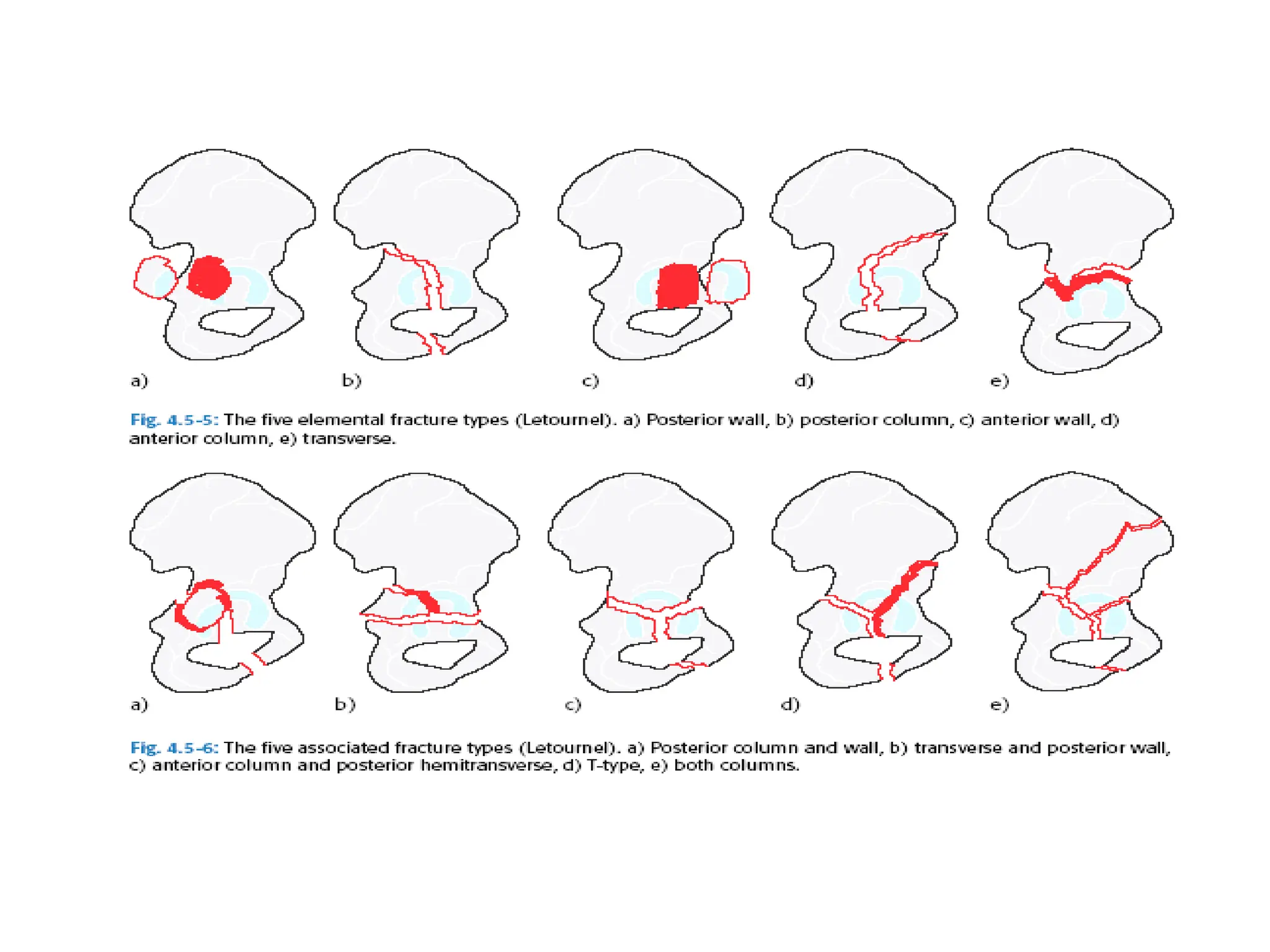 Acetabulum management fracture surgery.ppt