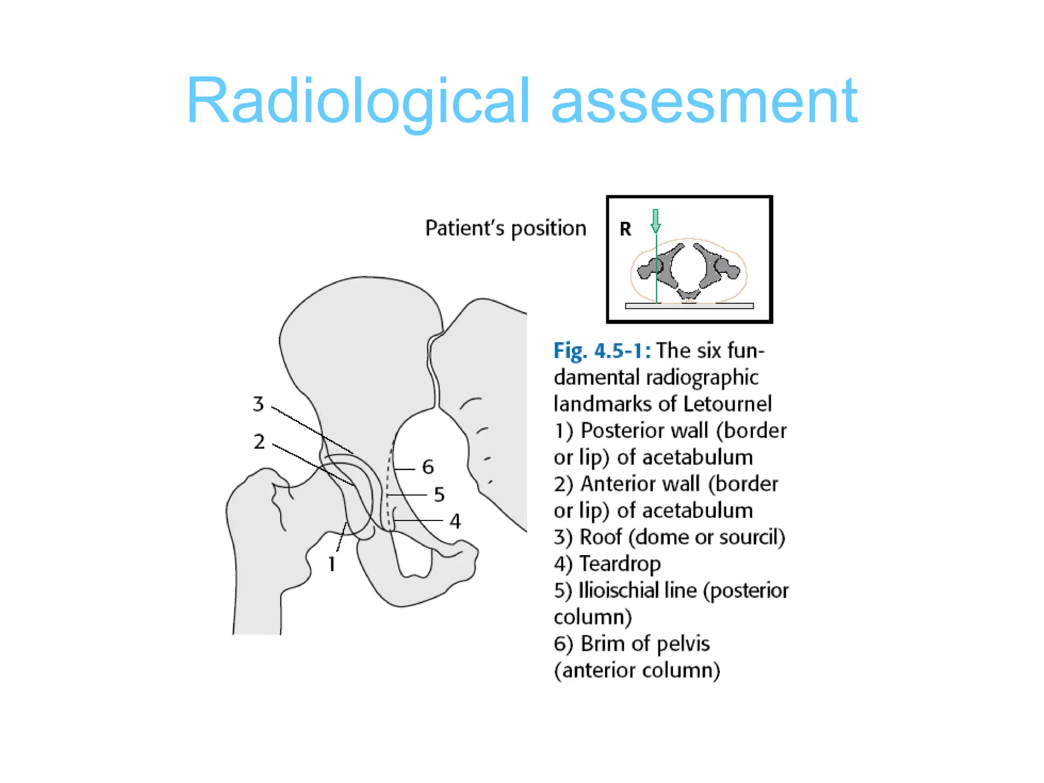 Acetabulum management fracture surgery.ppt