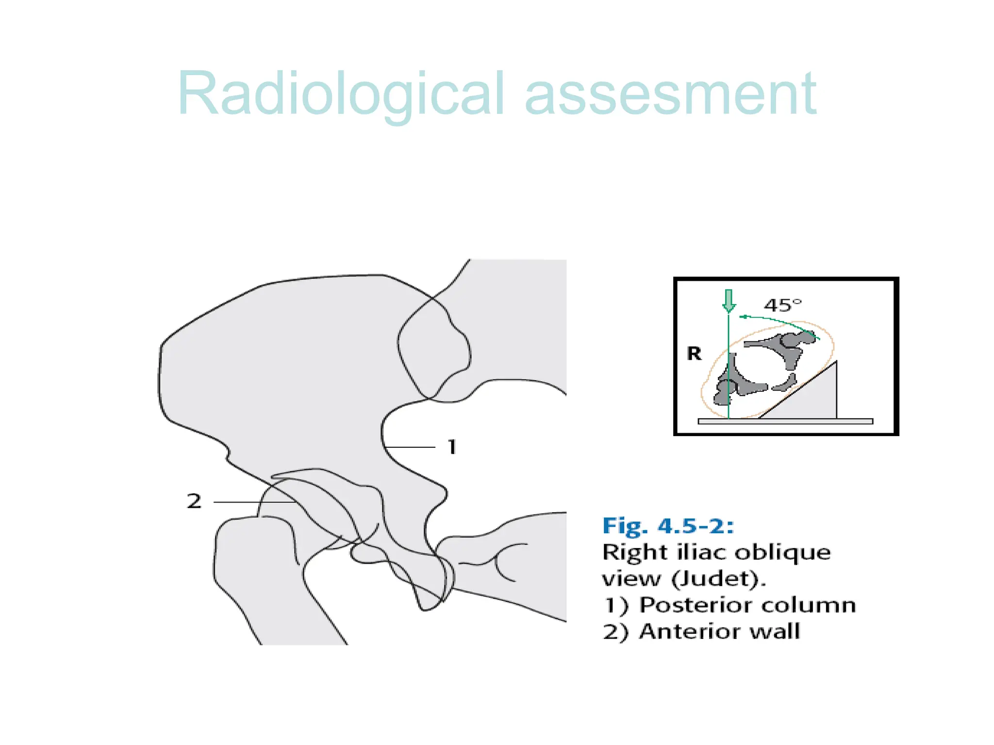 Acetabulum management fracture surgery.ppt