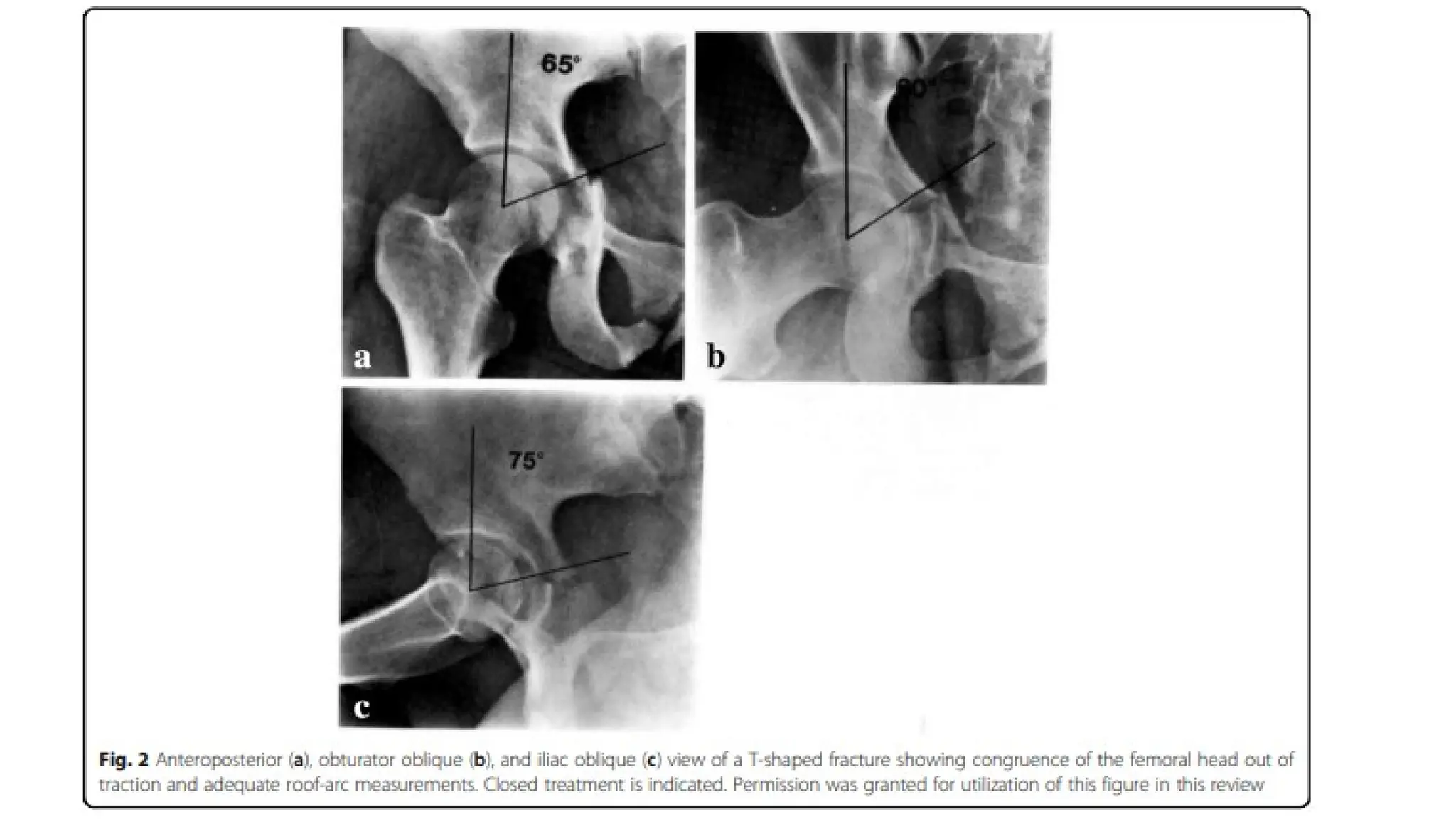 epidemiology and managment of acetabulum fracture by Dr.Akshat vijay.ppt