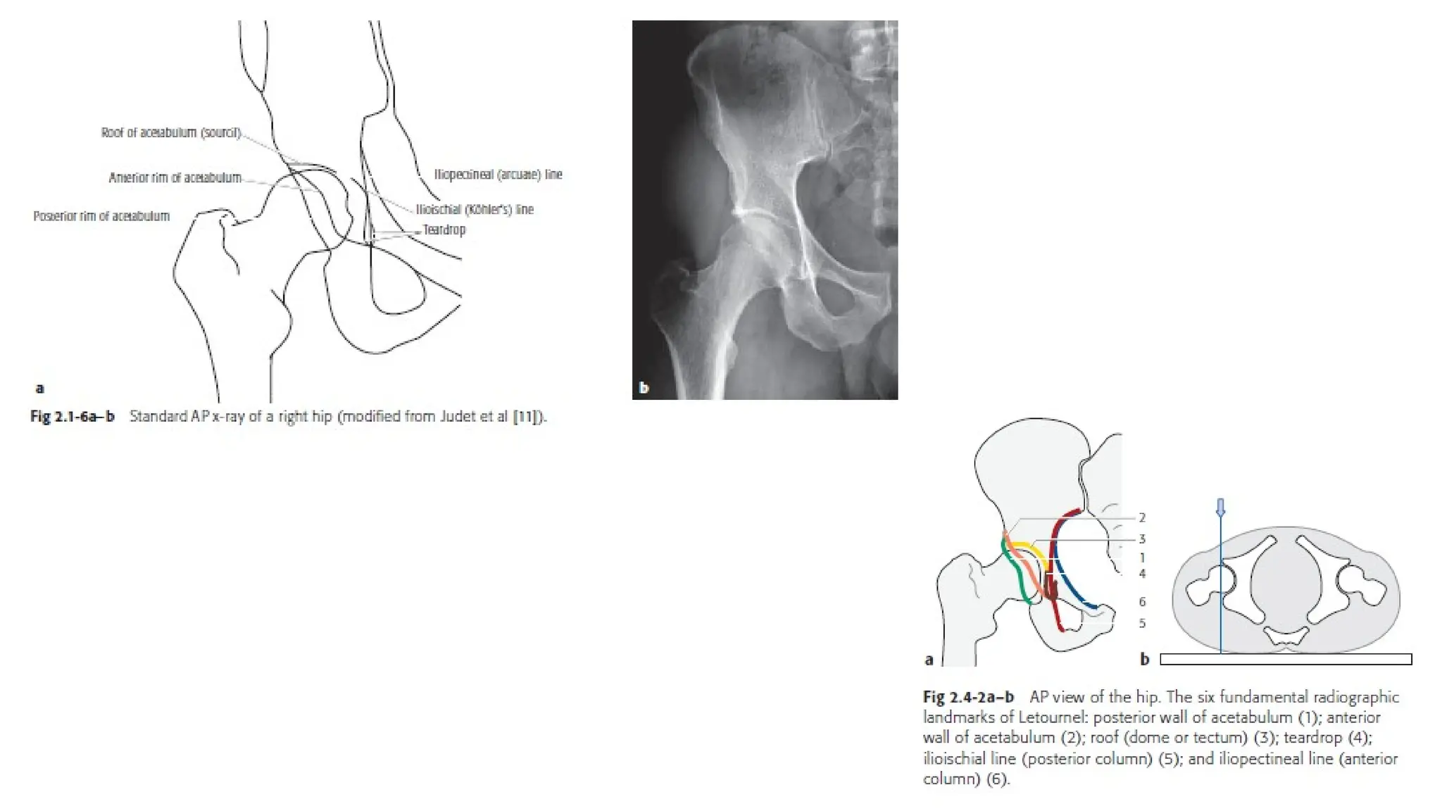 epidemiology and managment of acetabulum fracture by Dr.Akshat vijay.ppt