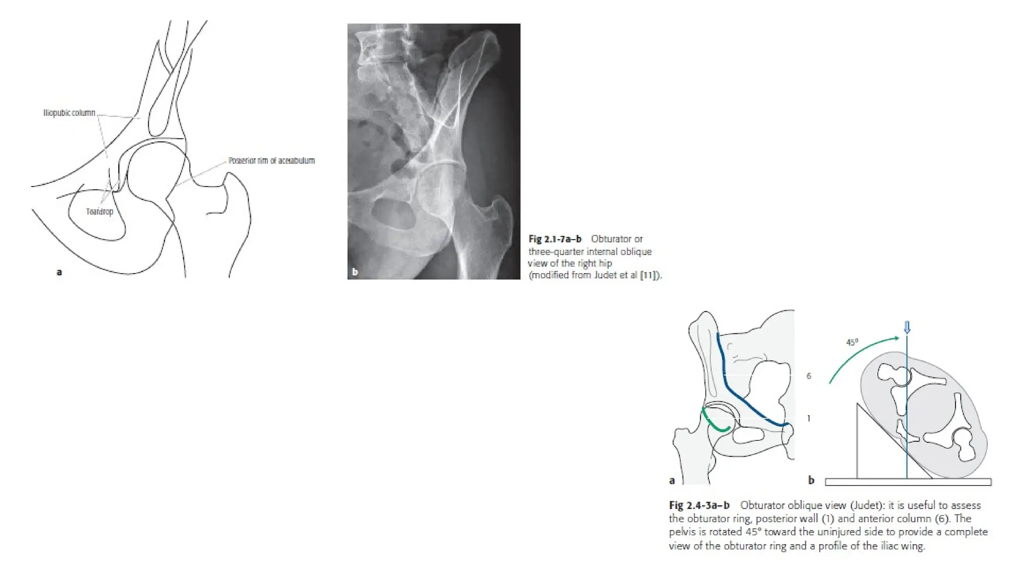 epidemiology and managment of acetabulum fracture by Dr.Akshat vijay.ppt
