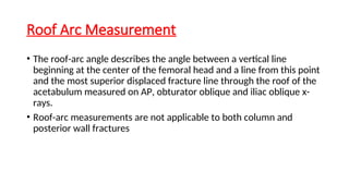 epidemiology and managment of acetabulum fracture by Dr.Akshat vijay.ppt