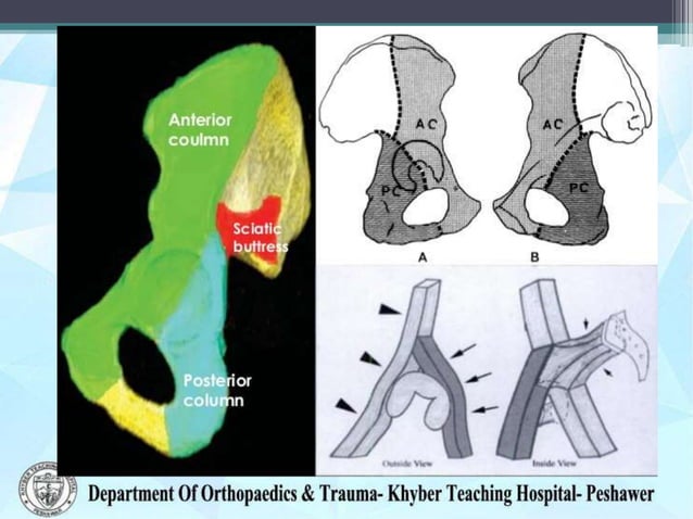 Acetabulum anatomy | PPTX