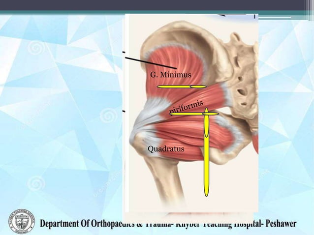 Acetabulum anatomy | PPTX