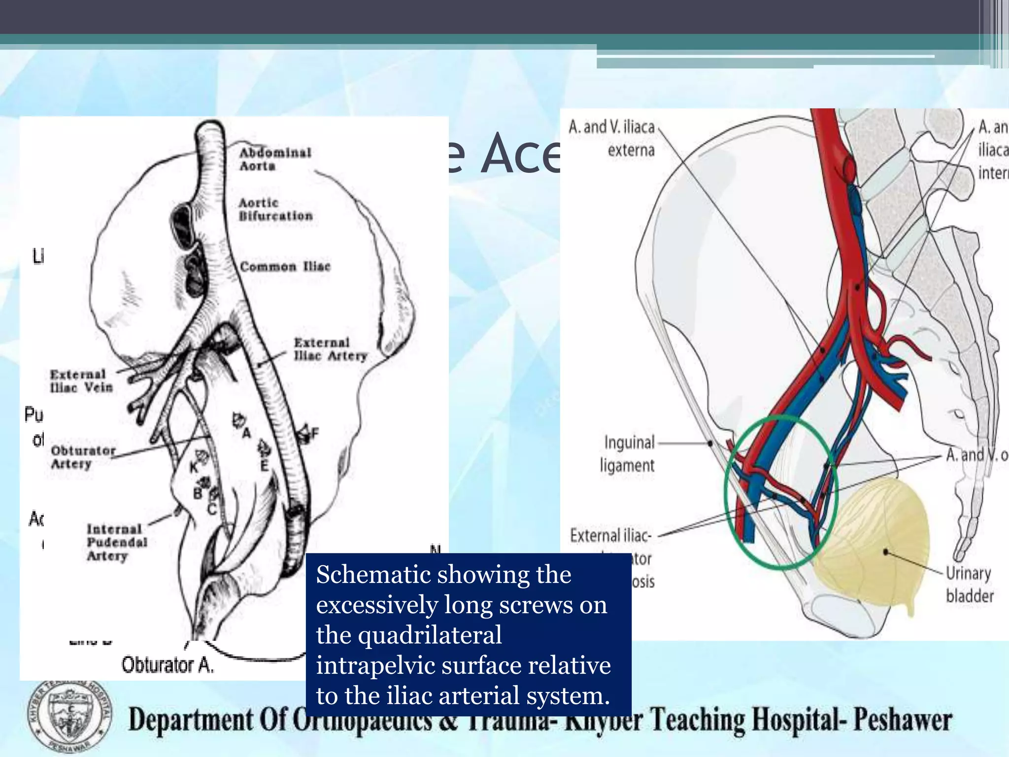 Acetabulum anatomy | PPTX