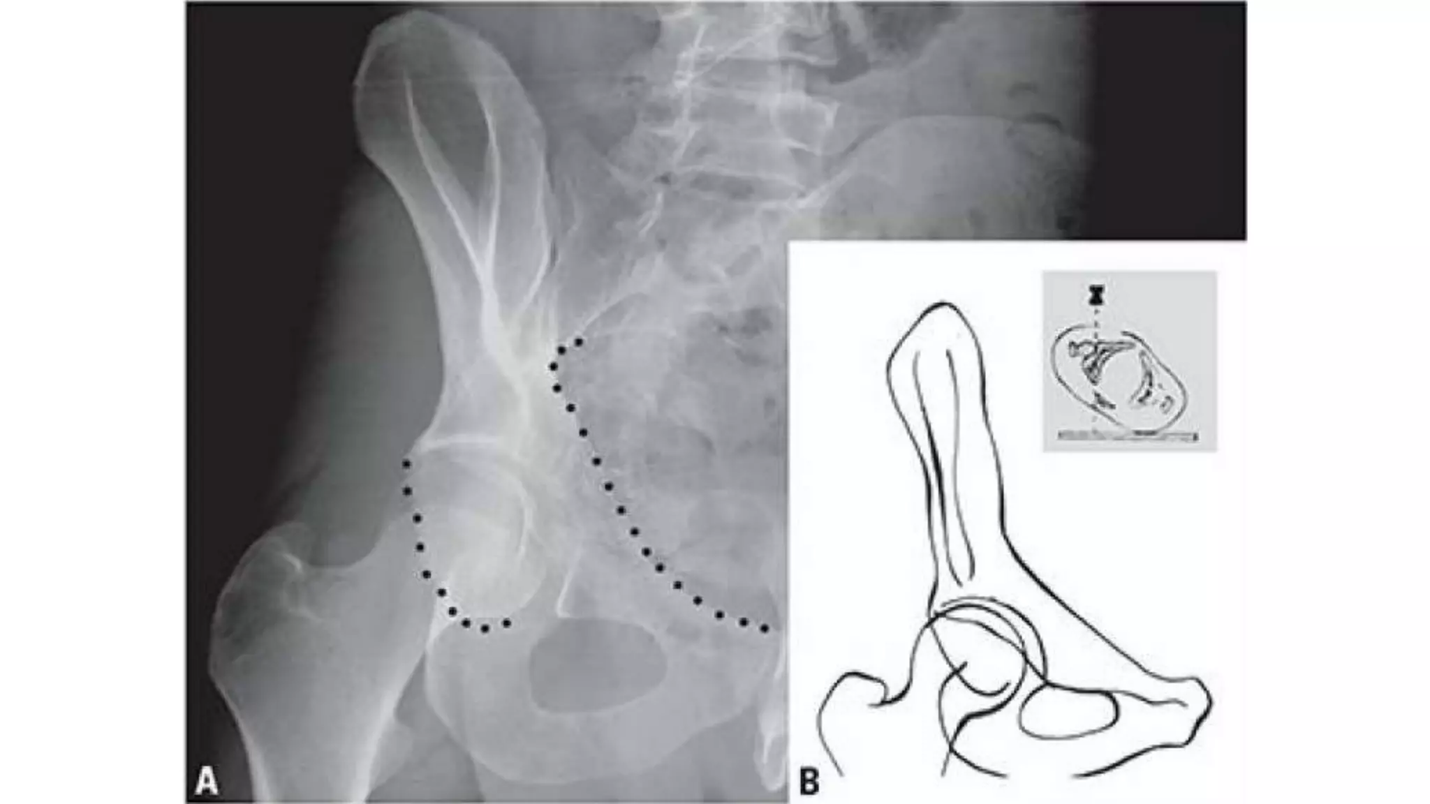 ACETABULUM And HIP DISLOCATION Report.pptx