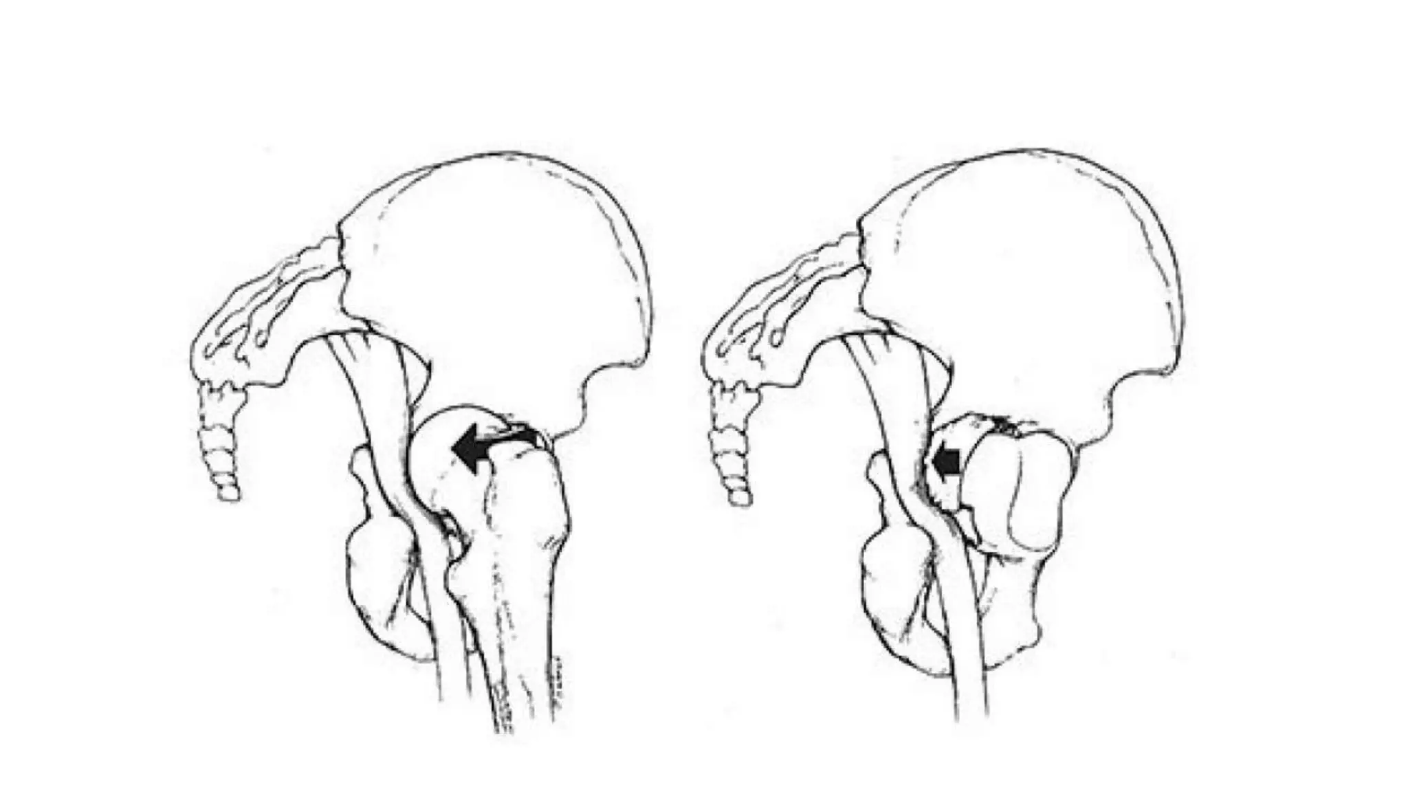 ACETABULUM And HIP DISLOCATION Report.pptx
