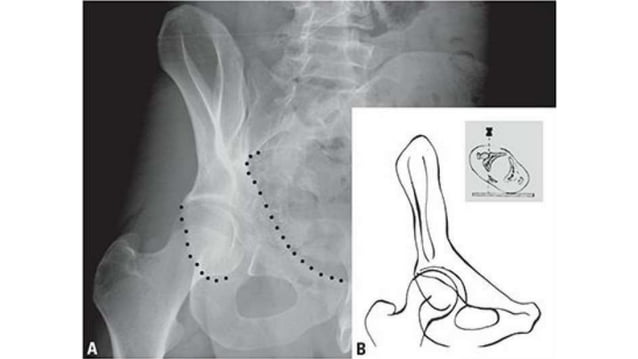 ACETABULUM And HIP DISLOCATION Report.pptx