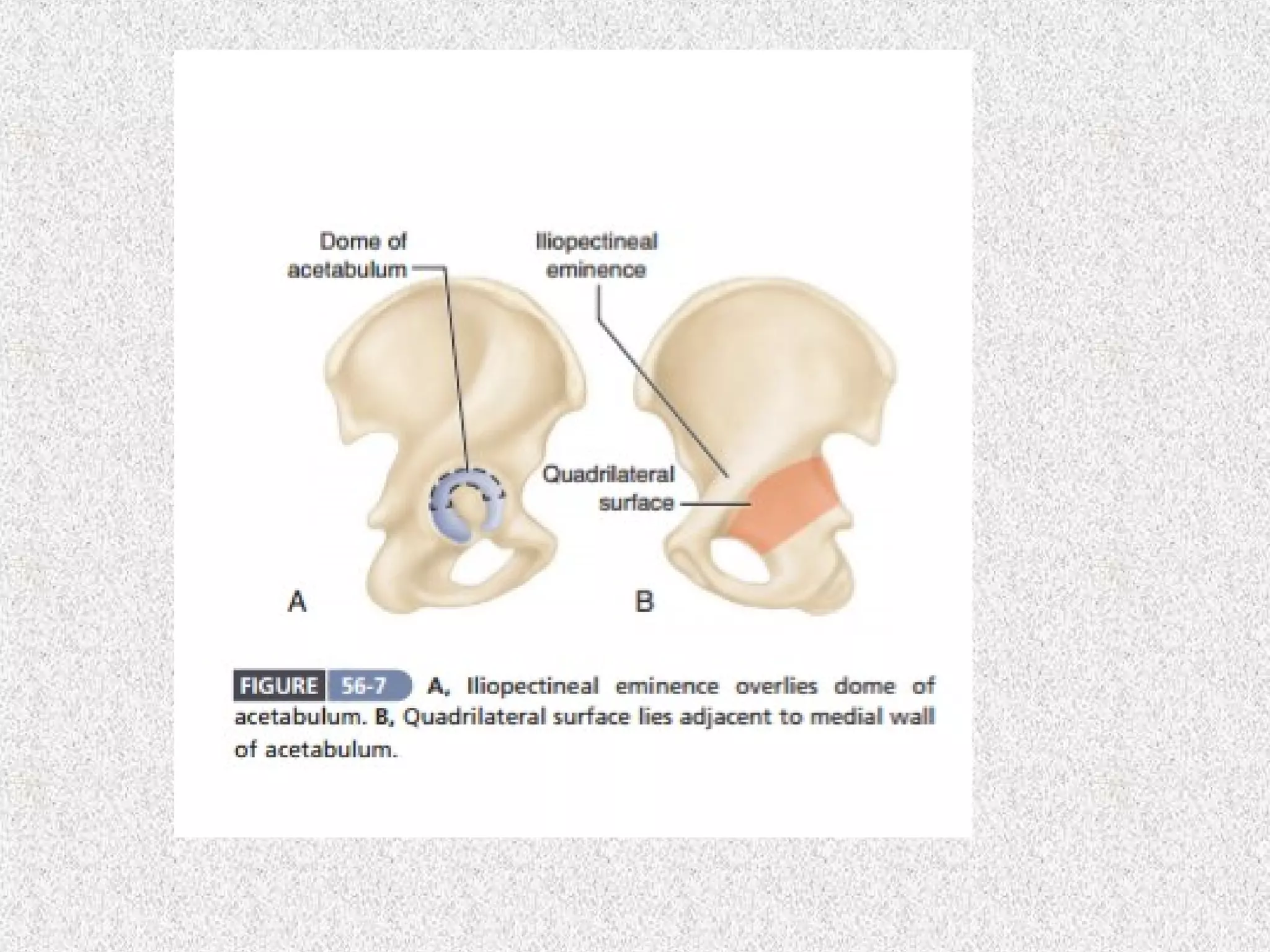 Acetabulum fracture | PPT