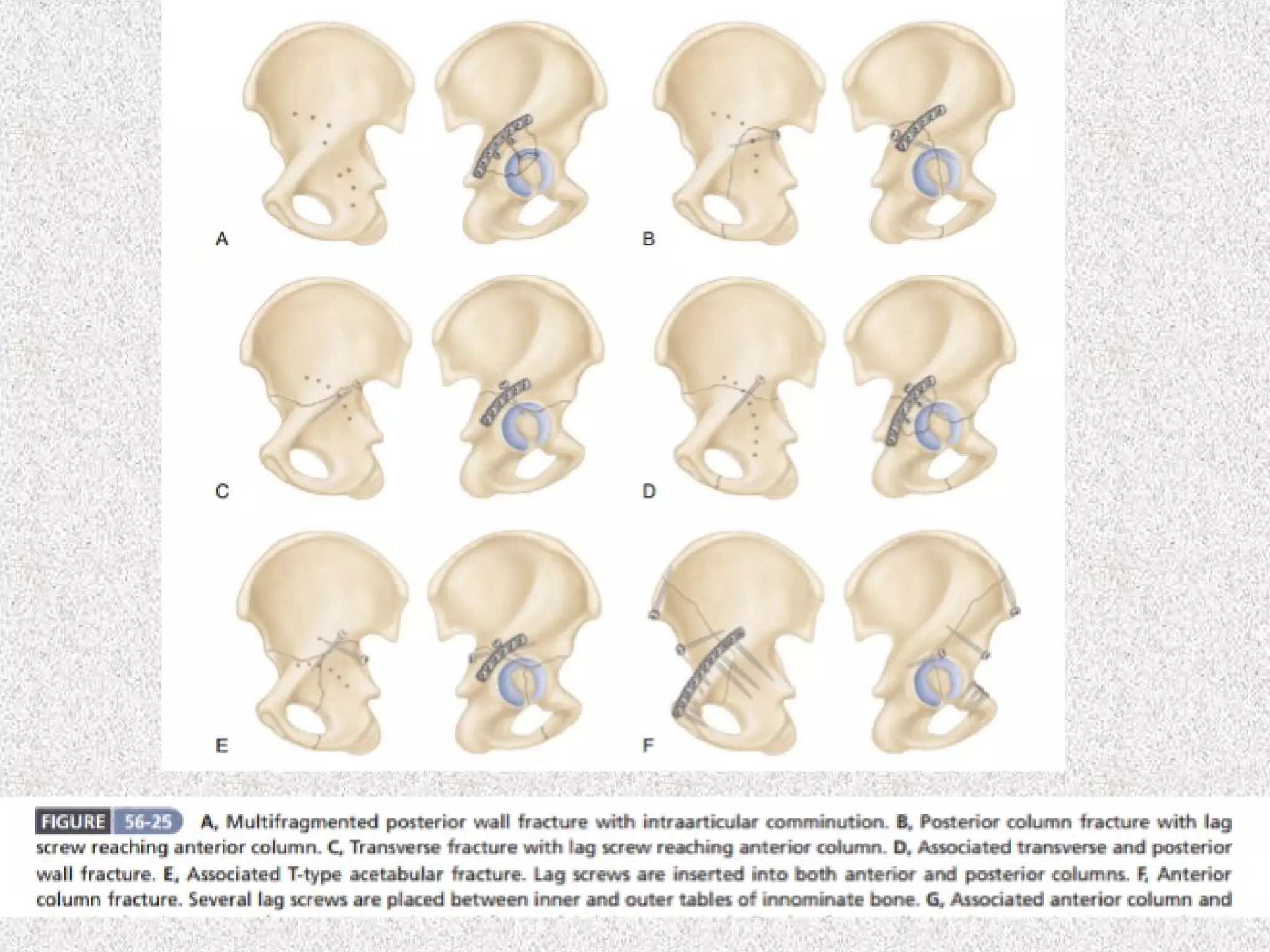 Acetabulum fracture | PPT