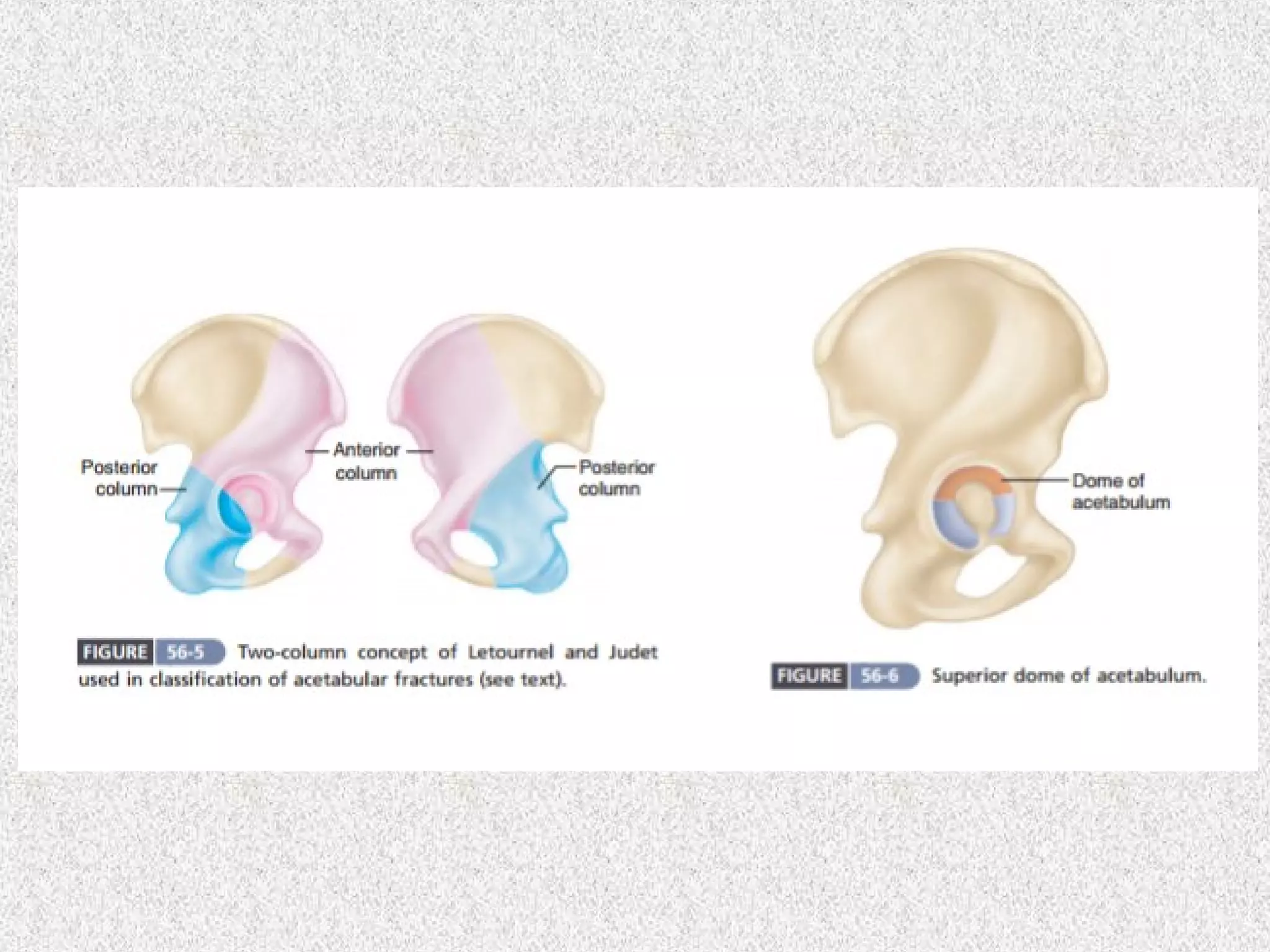 Acetabulum fracture | PPT | Death, Injury, or Military Conflict ...