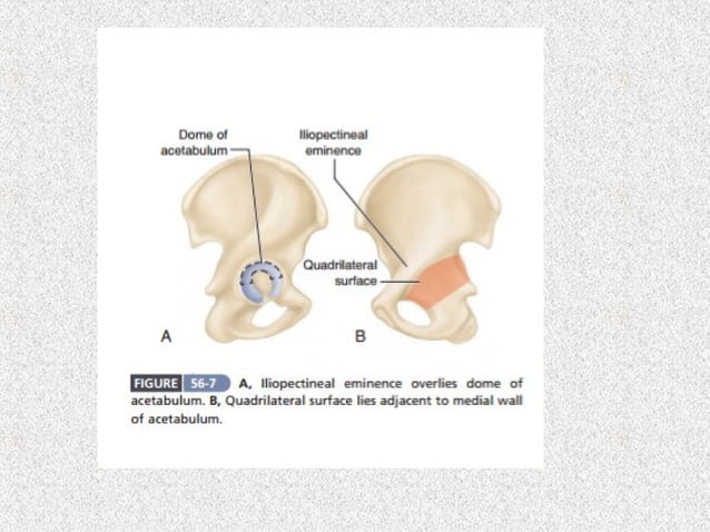Acetabulum fracture | PPT | Death, Injury, or Military Conflict ...