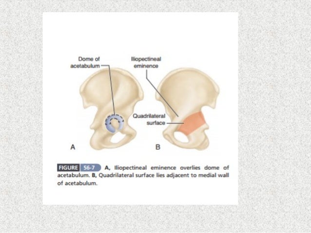 Acetabulum fracture