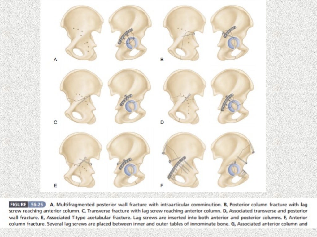 Acetabulum fracture