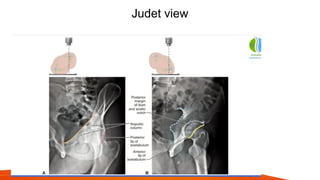 Acetabulum Fracture treatment and classification | PPTX