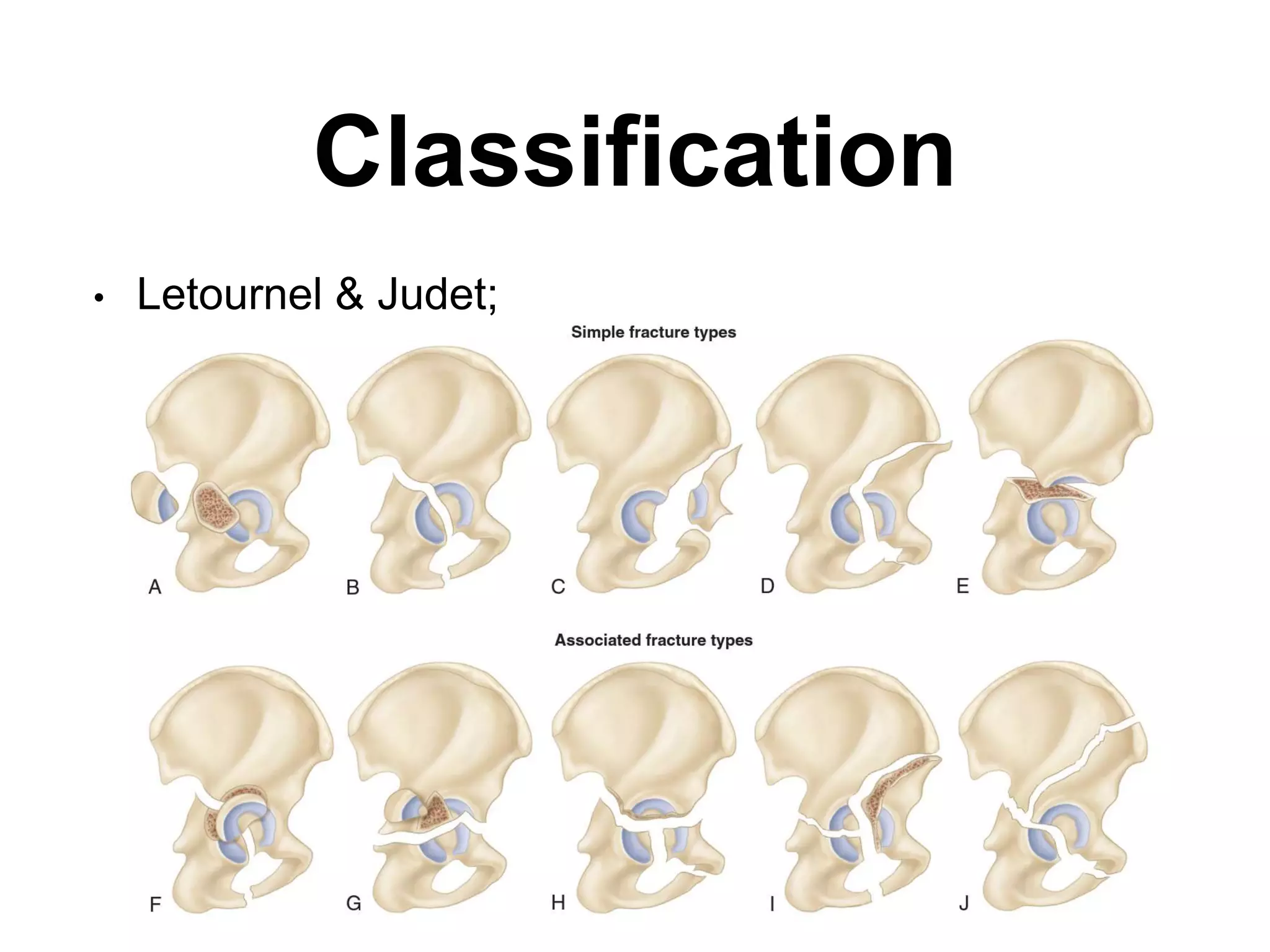 Acetabulum Fracture | PPTX