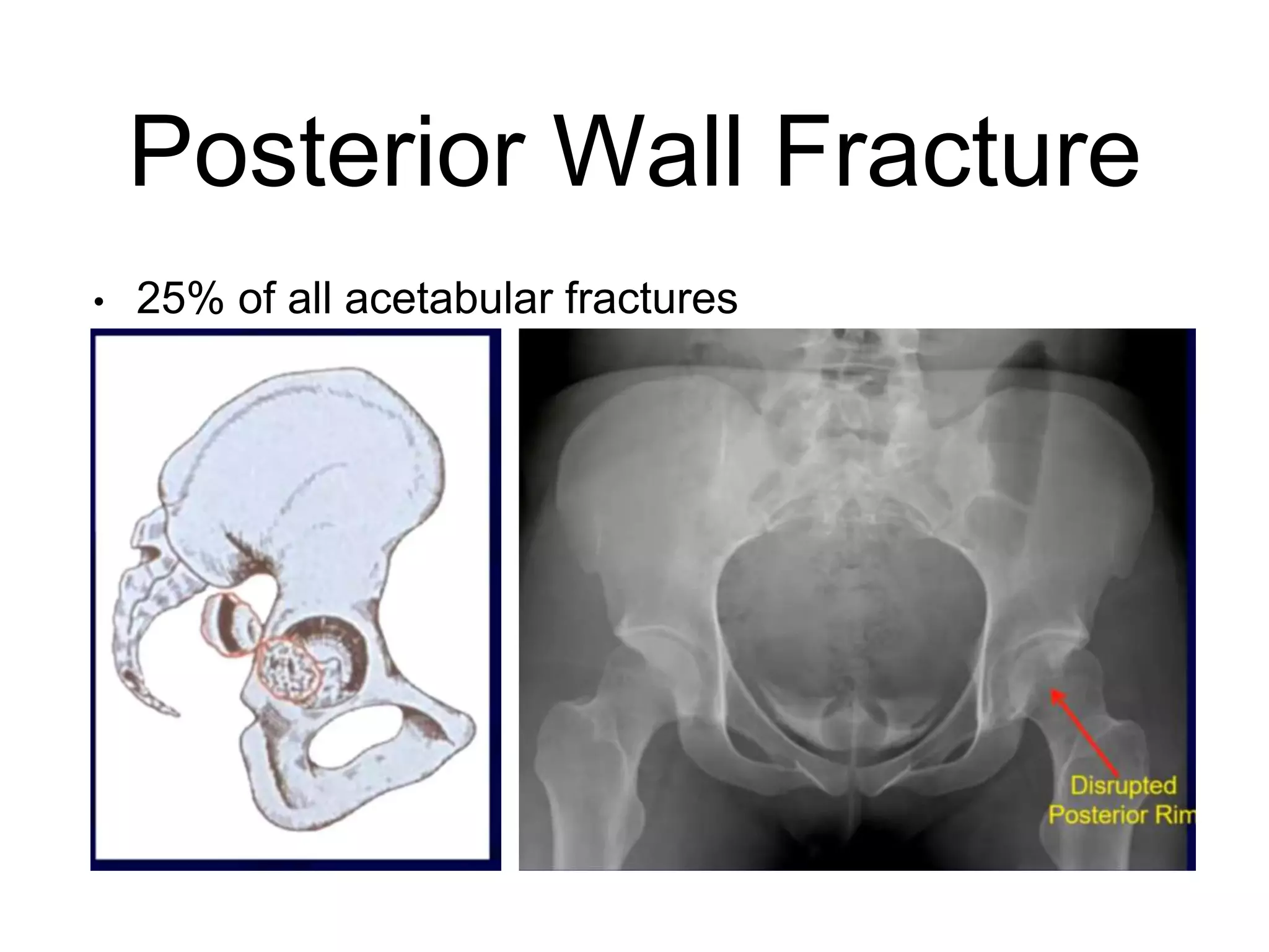 Acetabulum Fracture | PPTX
