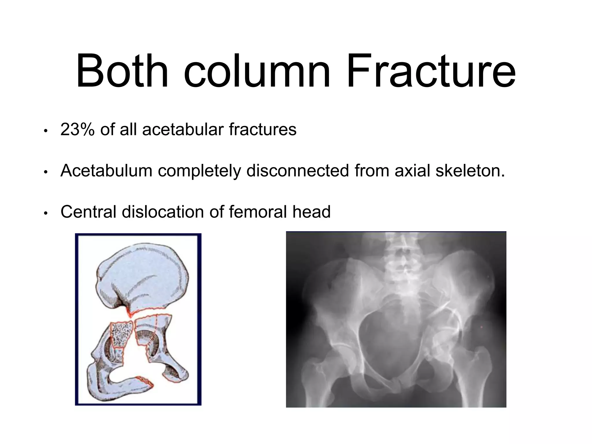 Acetabulum Fracture | PPTX