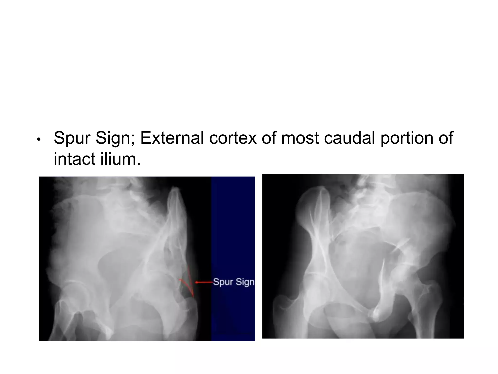 Acetabulum Fracture | PPTX