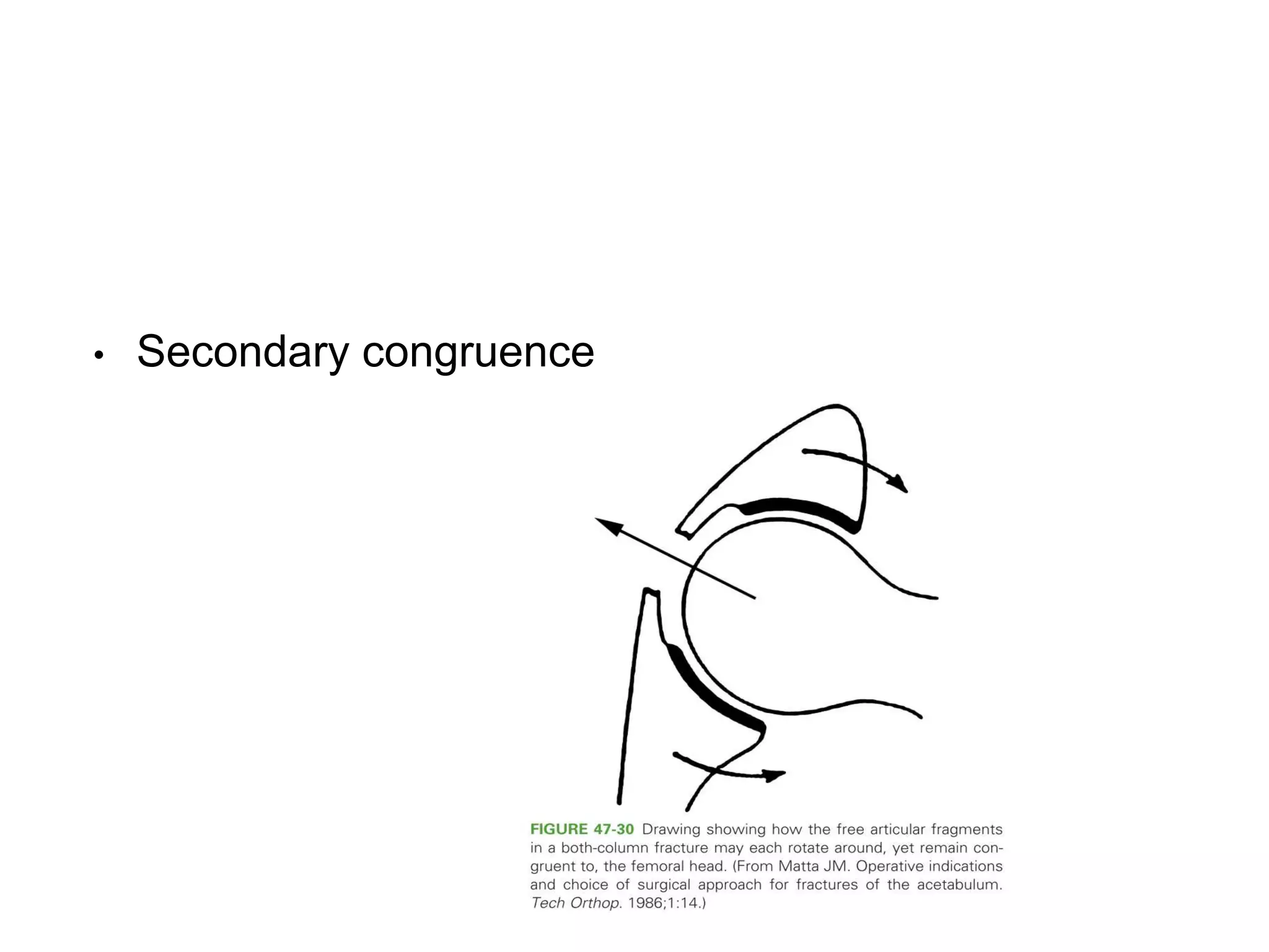 Acetabulum Fracture | PPTX